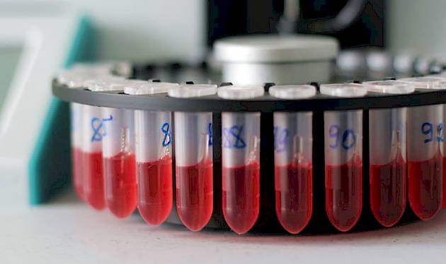 Addisonova bolest - CentarZdravlja